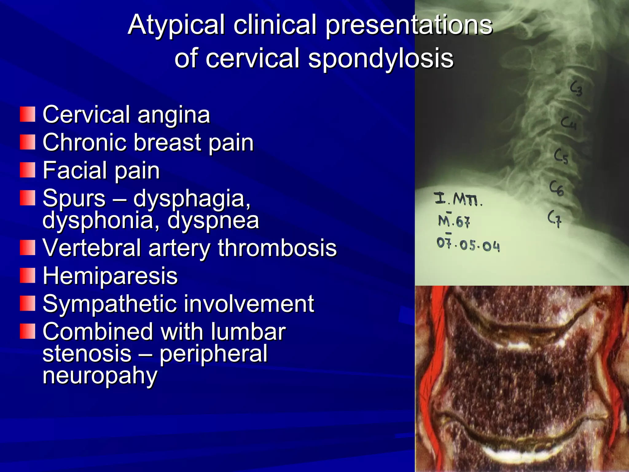 Cervical Myelopathy 2016 | PPT