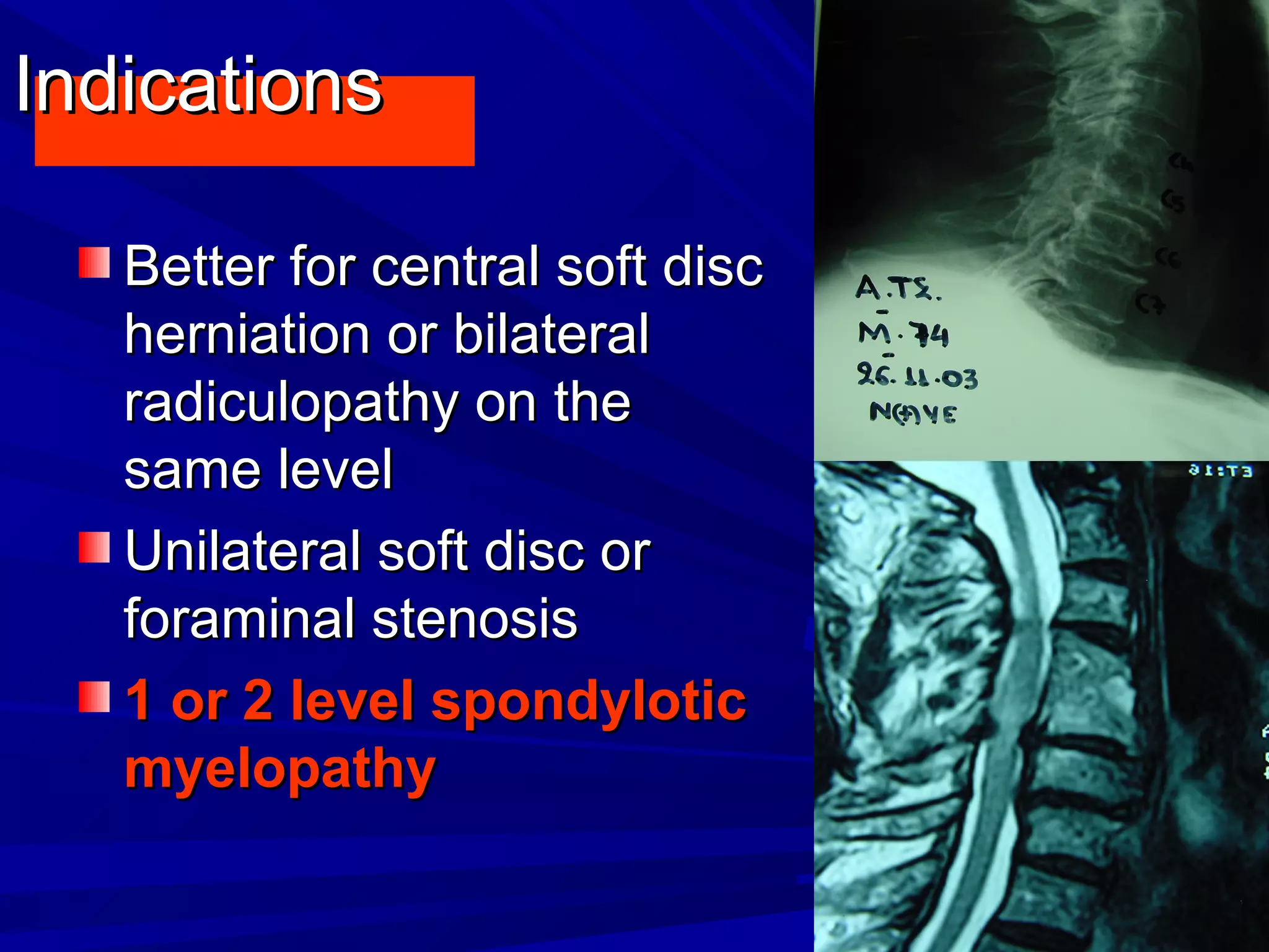 Cervical Myelopathy 2016 | PPT