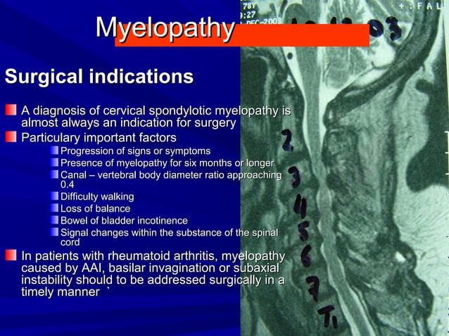 Cervical Myelopathy 2016 | PPT