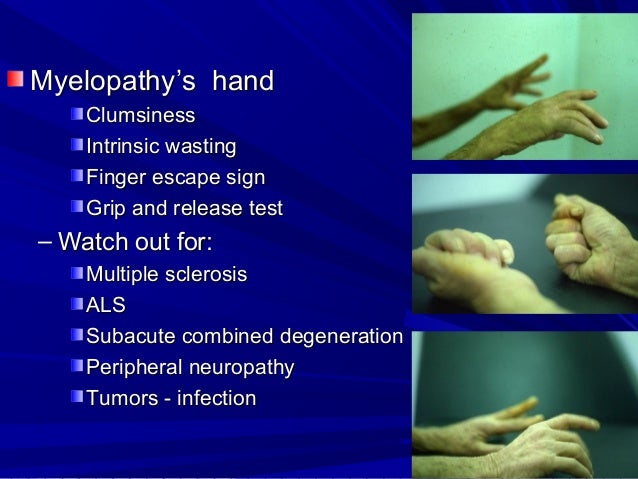 Cervical Myelopathy 2016