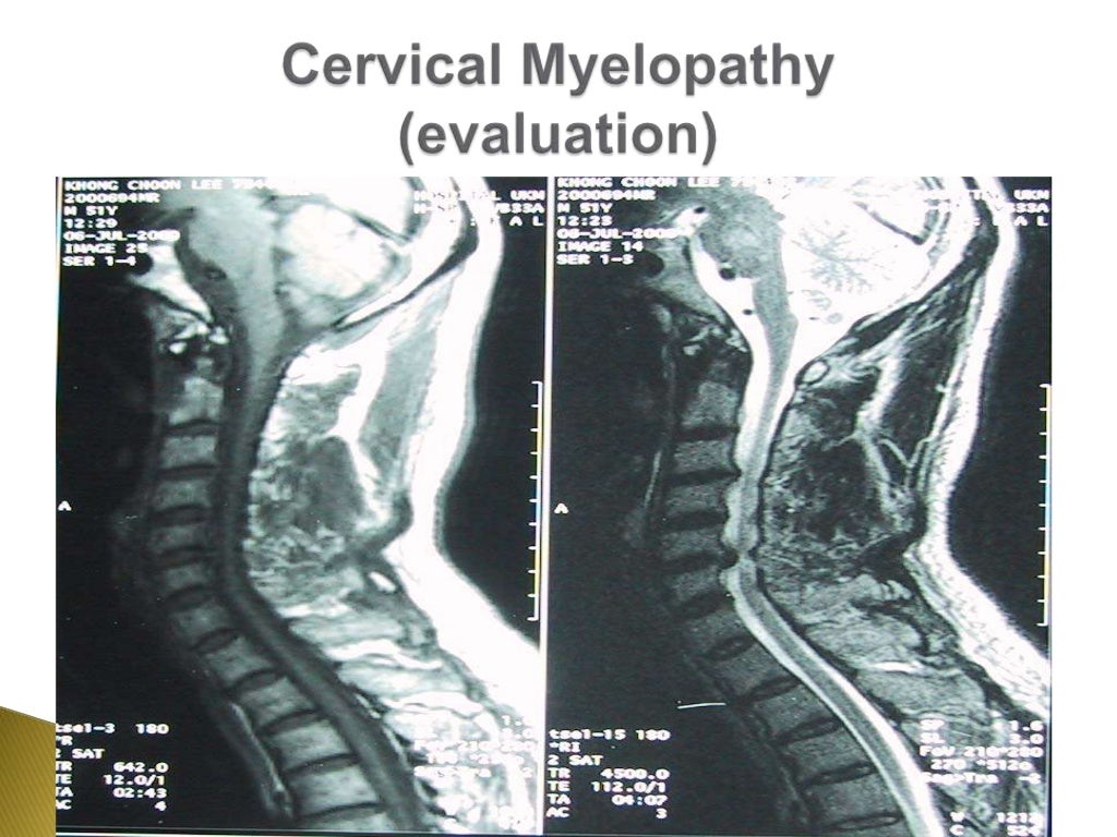 Cervical myelopathy cme