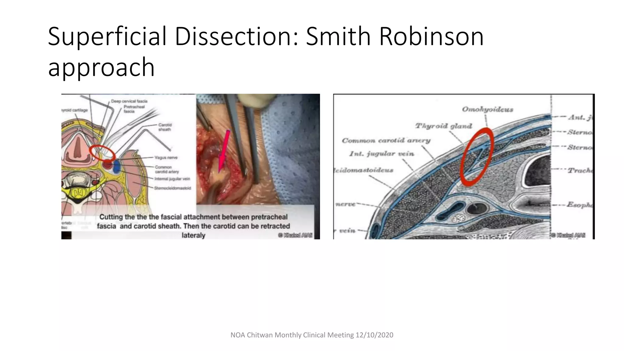 Cervical myelopathy | PPTX