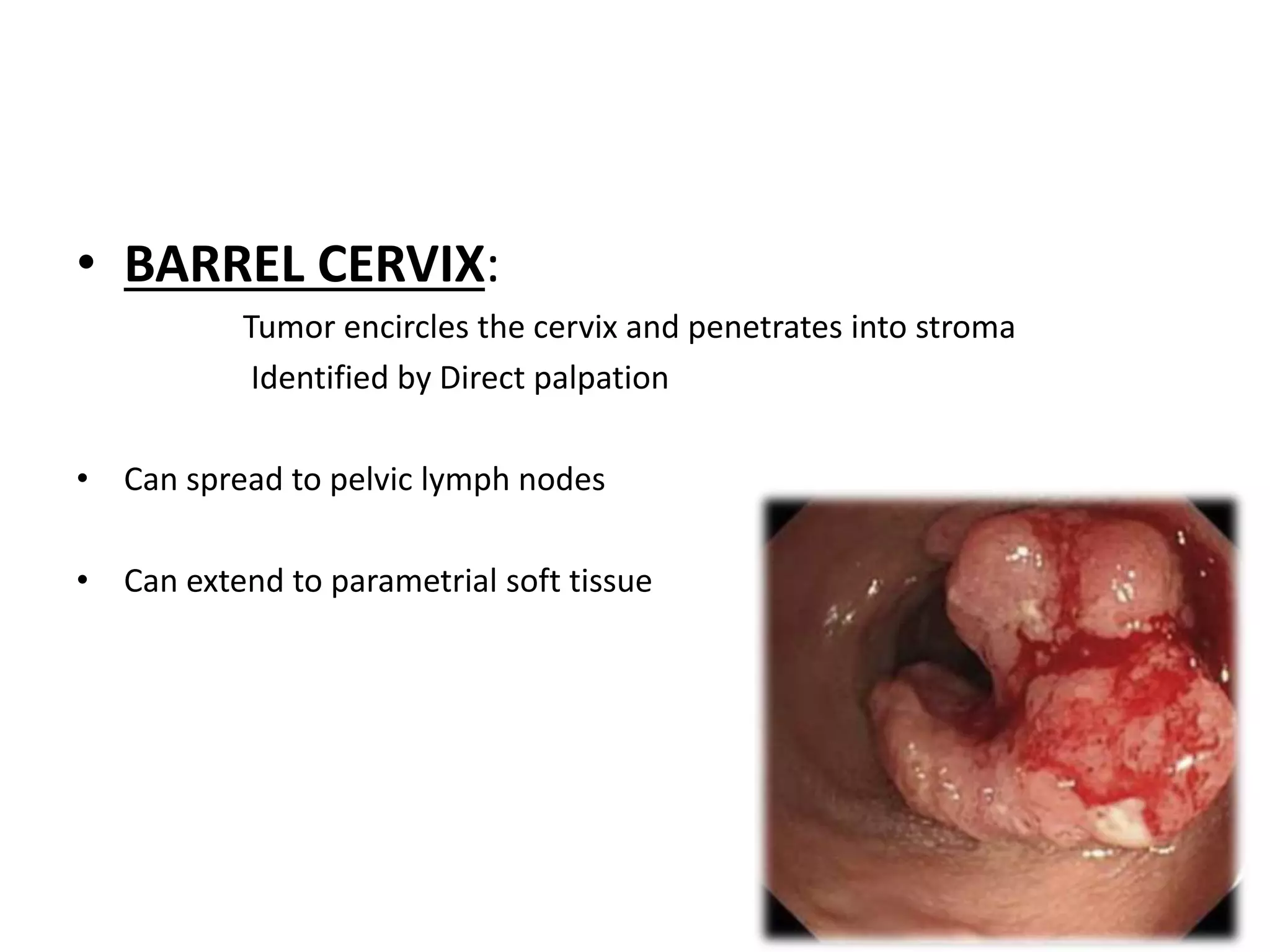 Cervical neoplasms | PPTX