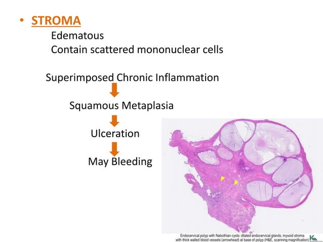Cervical neoplasms | PPTX