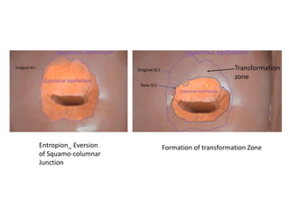 Cervical neoplasms | PPTX
