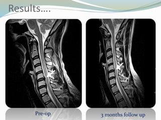 Cervical Nucleoplasty – Percutaneous cervical disc decompression – SQPSDH
