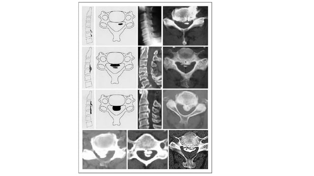 Cervical opll | PPTX