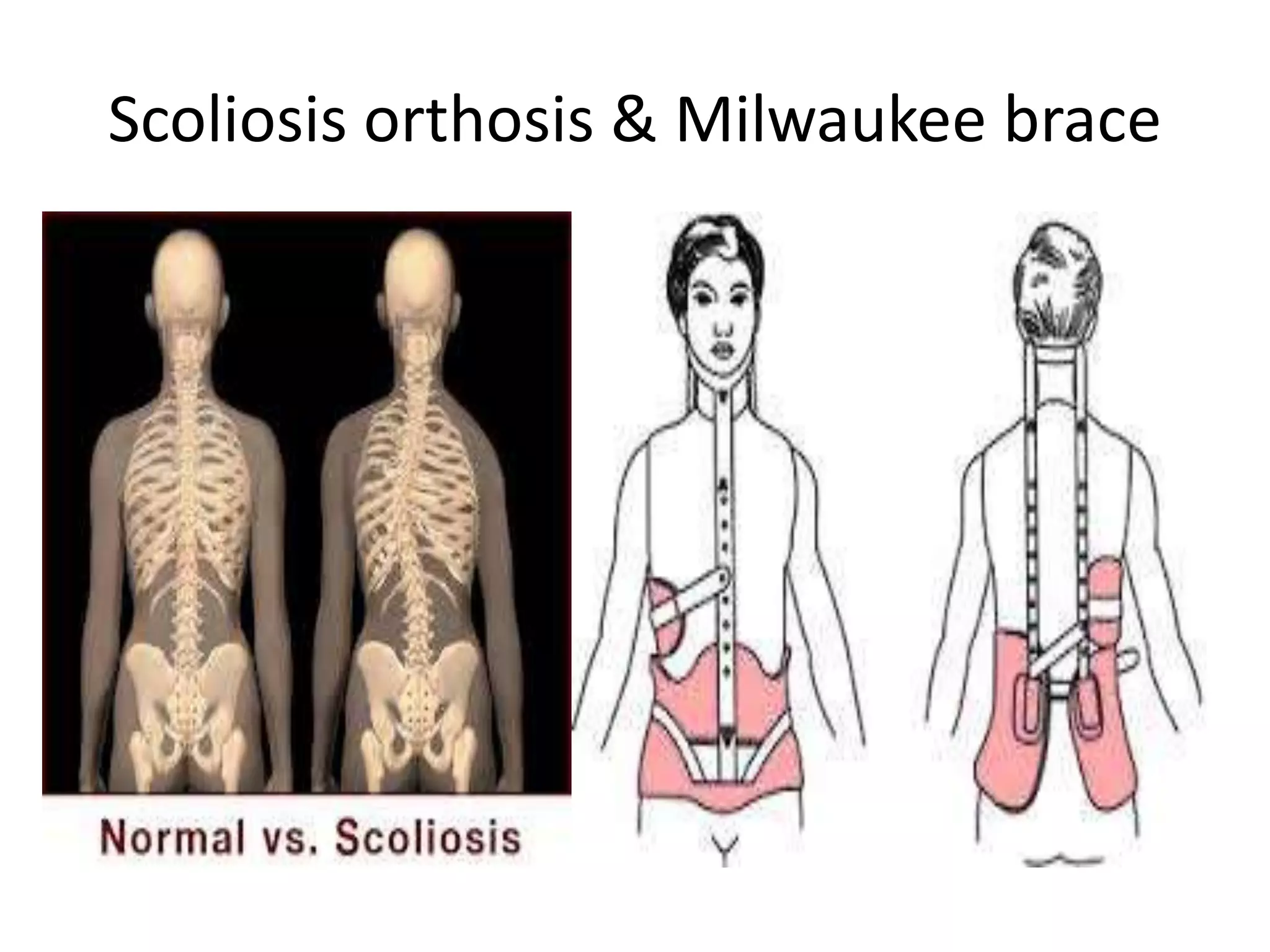 Cervical orthosis | PPTX
