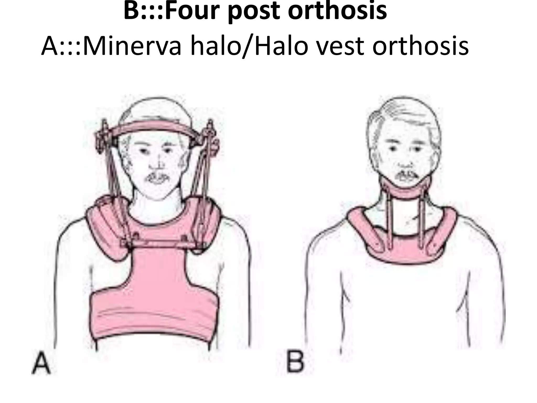 Cervical orthosis | PPTX