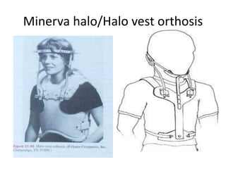 Minerva Orthosis