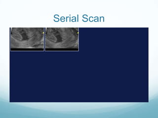 Cervical pregnancy | PPTX