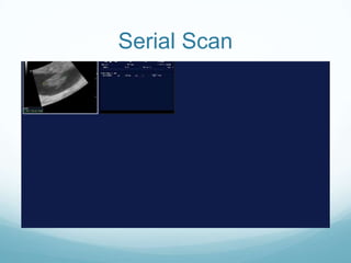 Cervical pregnancy | PPTX