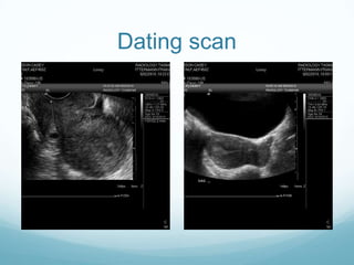 Cervical pregnancy | PPT