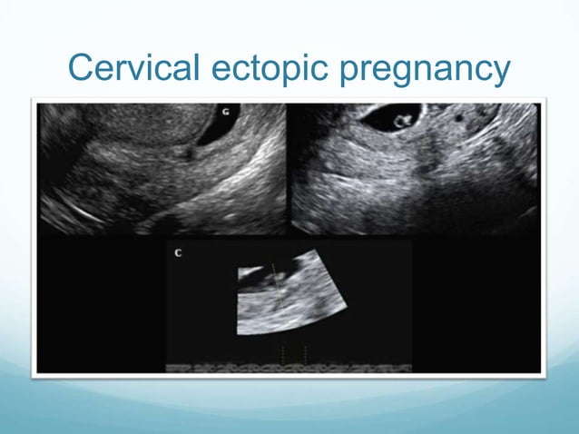Cervical pregnancy | PPT