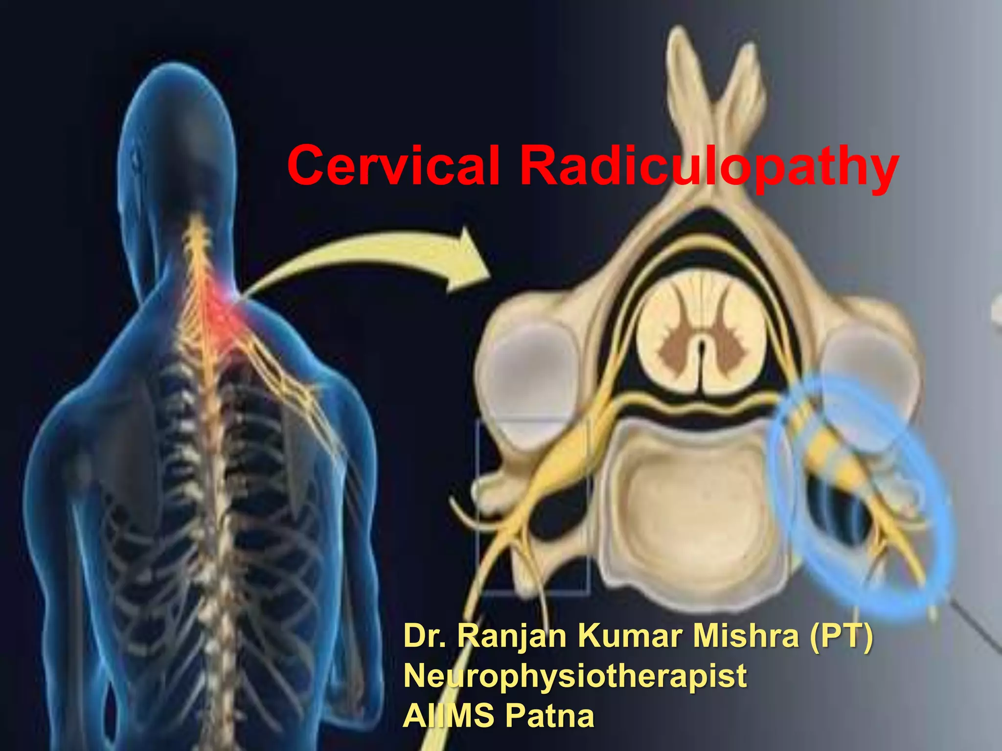 Cervical radiculopathy | PPTX