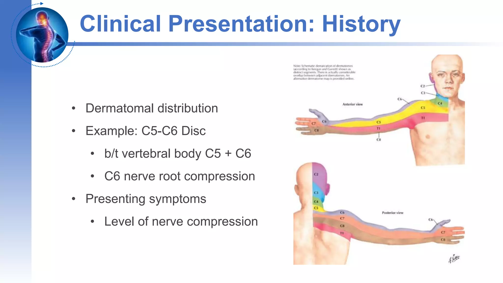 Cervical radiculopathy | PPTX