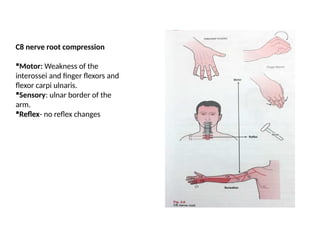 Cervical Radiculopathy and its management.pptx