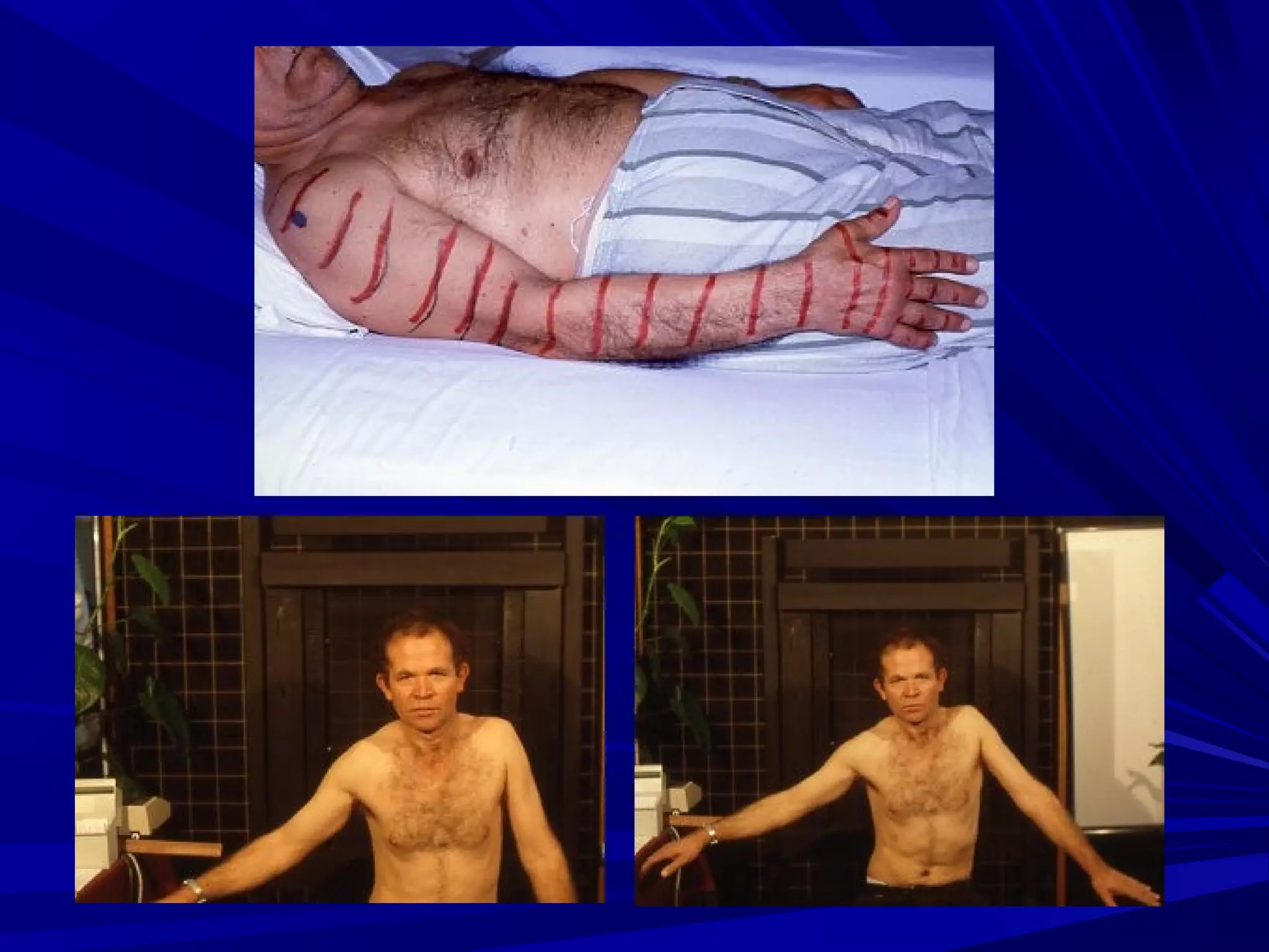 Cervical radiculopathy 1st mech diag 2008 | PPT