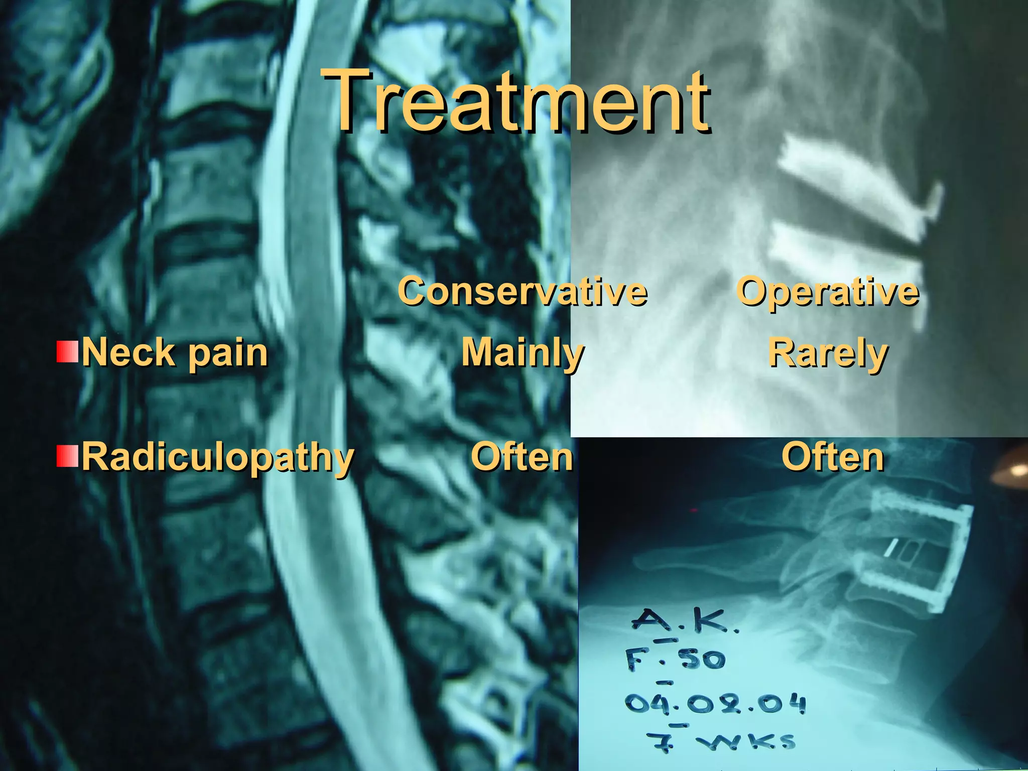 Cervical Radiculopathy 1st Mech Diag 2008 Ppt