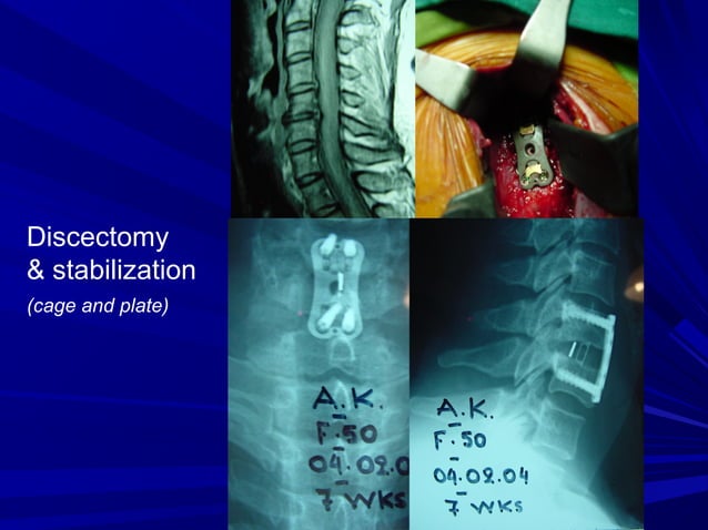 Cervical Radiculopathy 1st Mech Diag 2008 Ppt