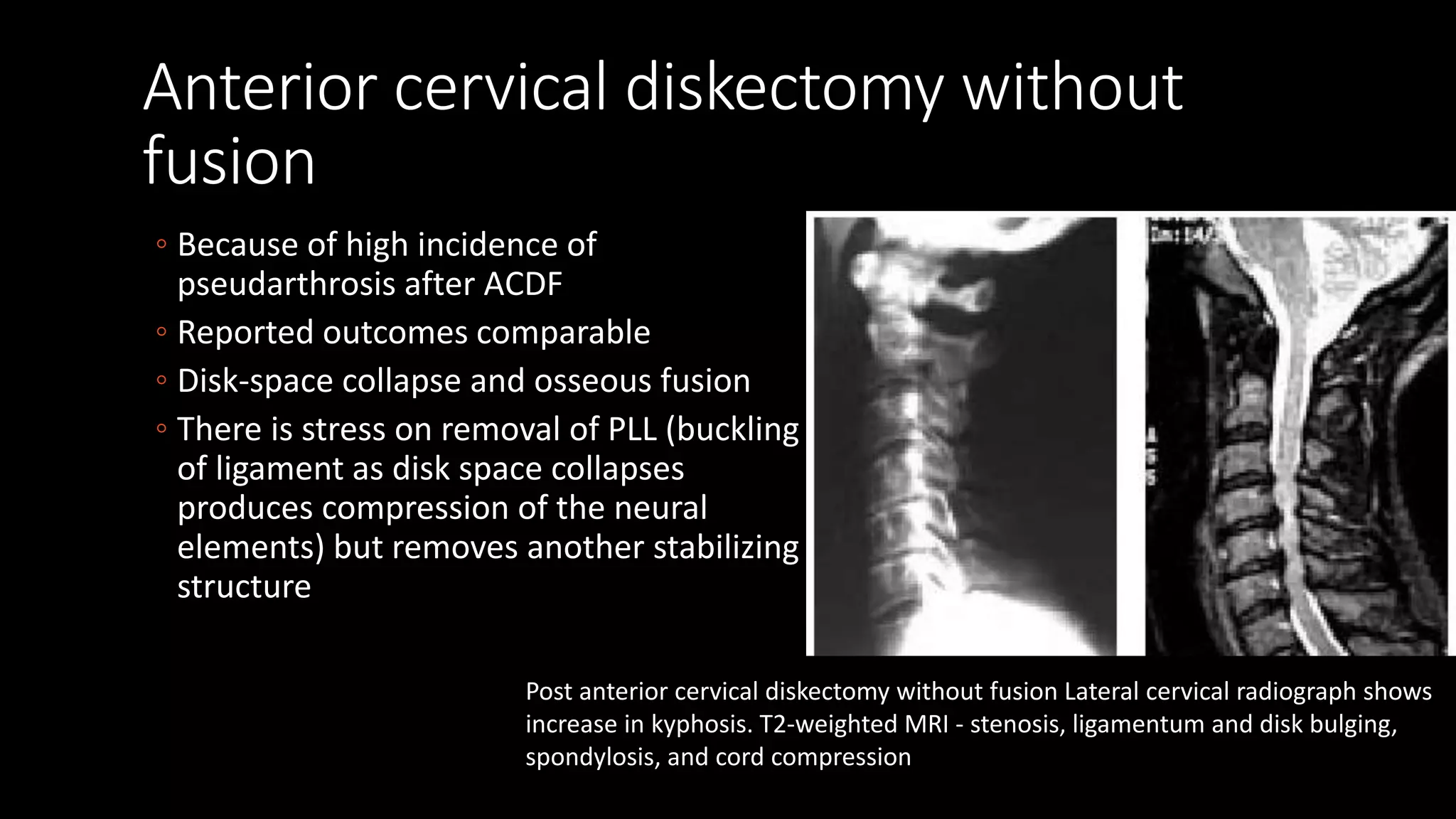 Cervical radiculopathy | PPSX