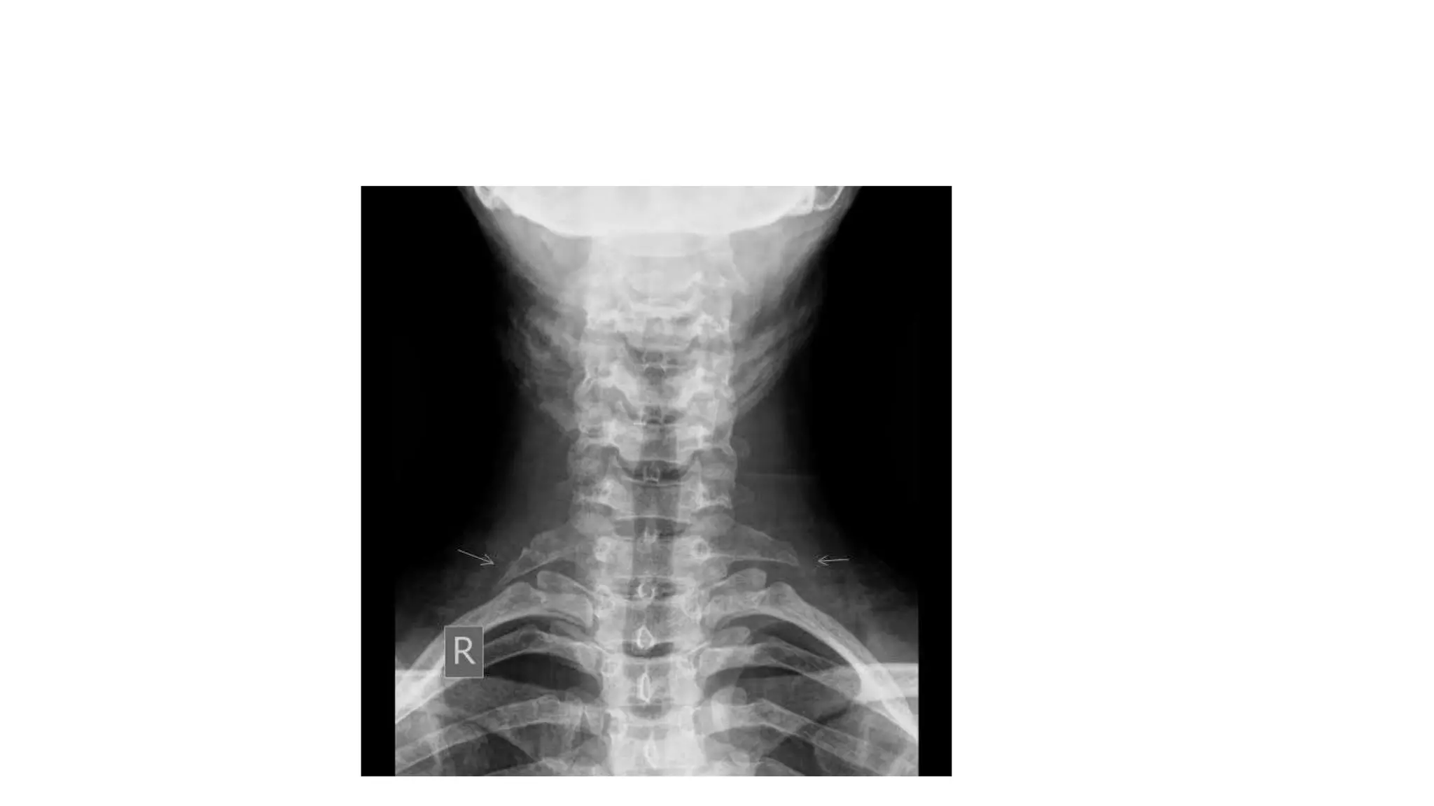 Cervical rib | PPTX