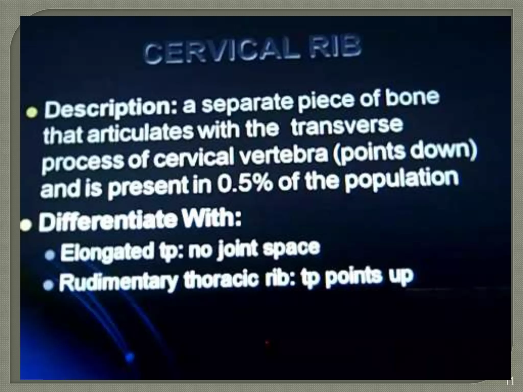Cervical rib | PPTX | Death, Injury, or Military Conflict | Sensitive ...