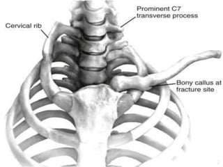 Cervical rib | PPT