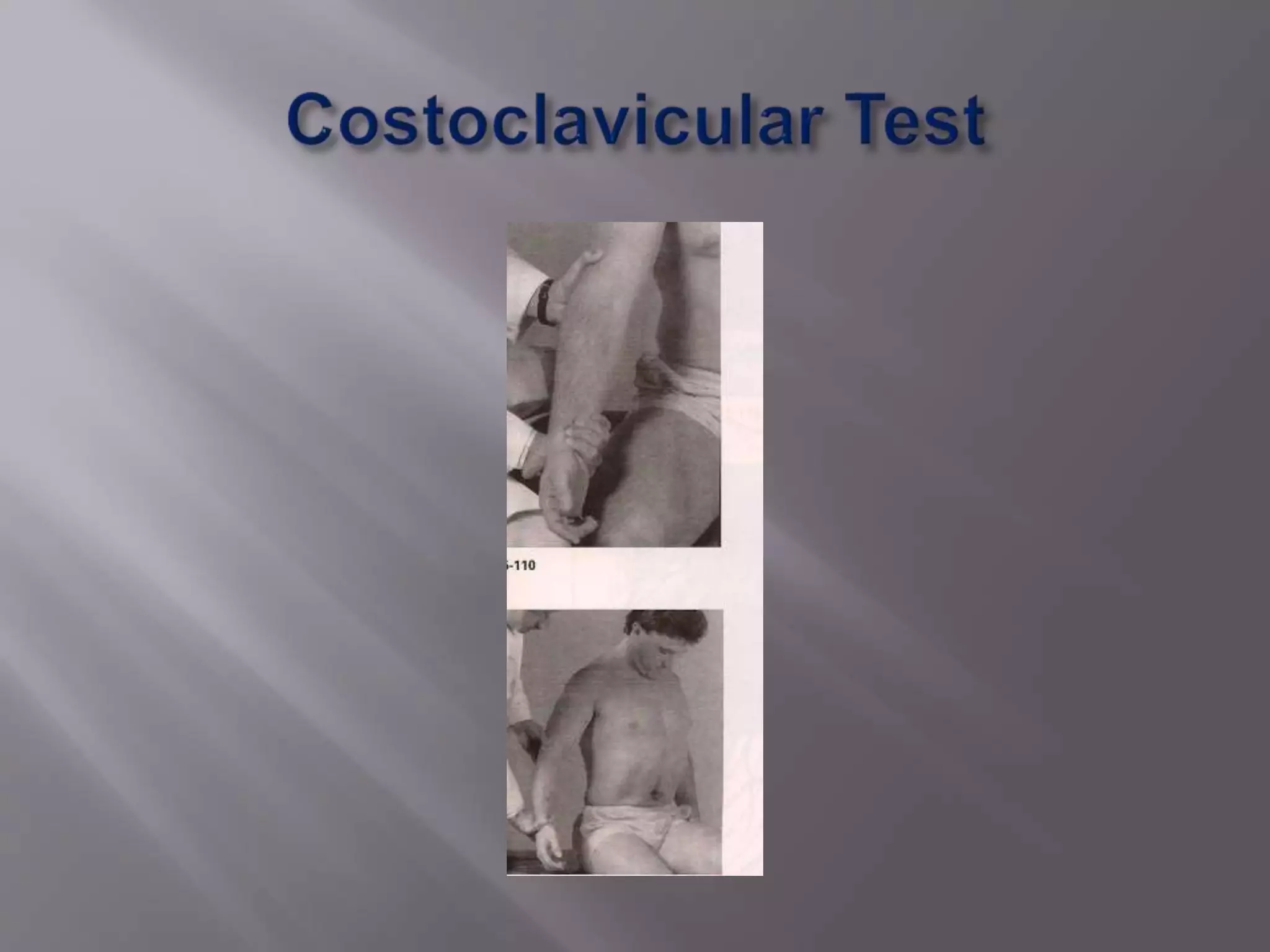 Cervical rib syndrome | PPTX