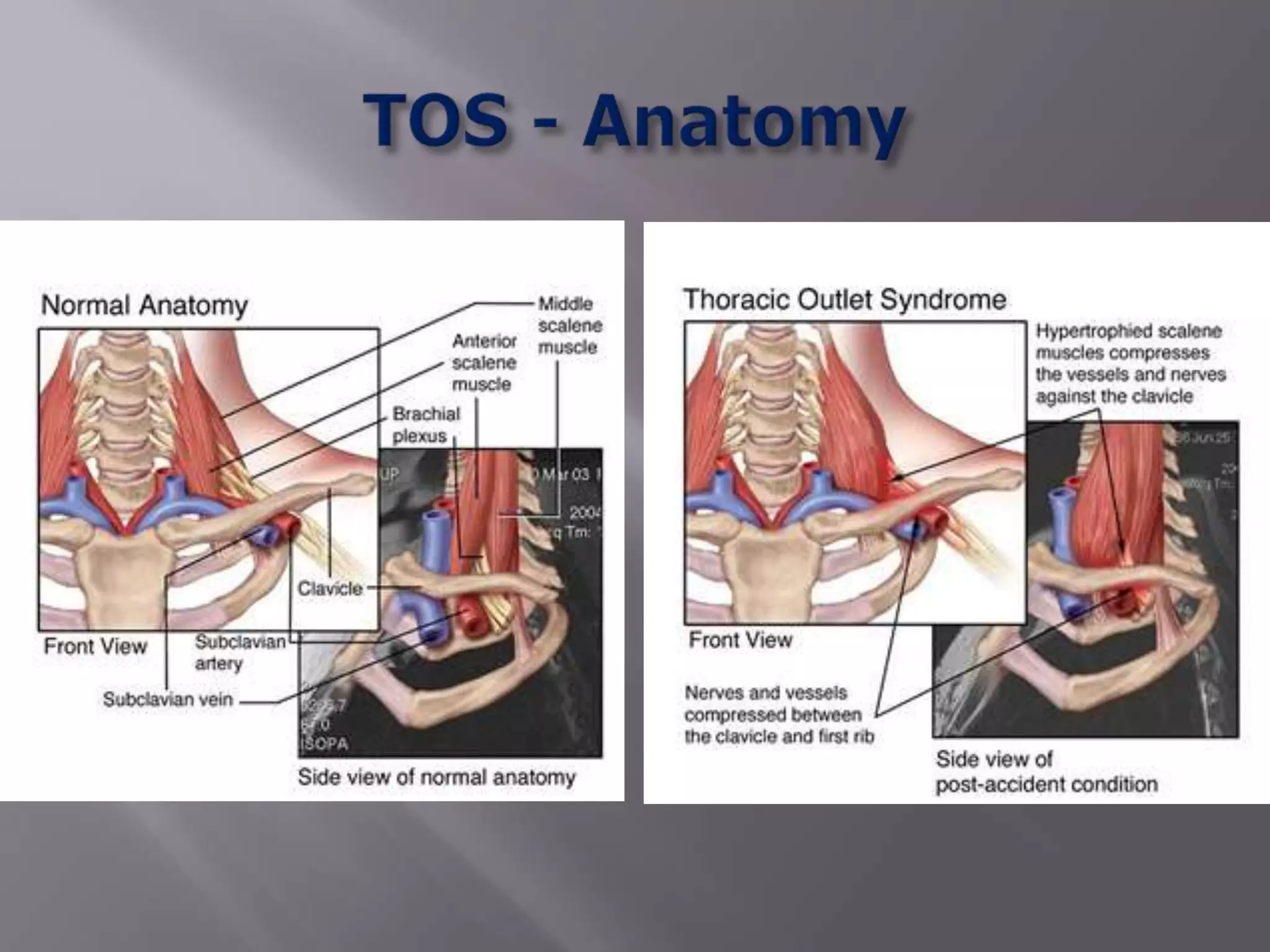 Cervical rib syndrome | PPTX