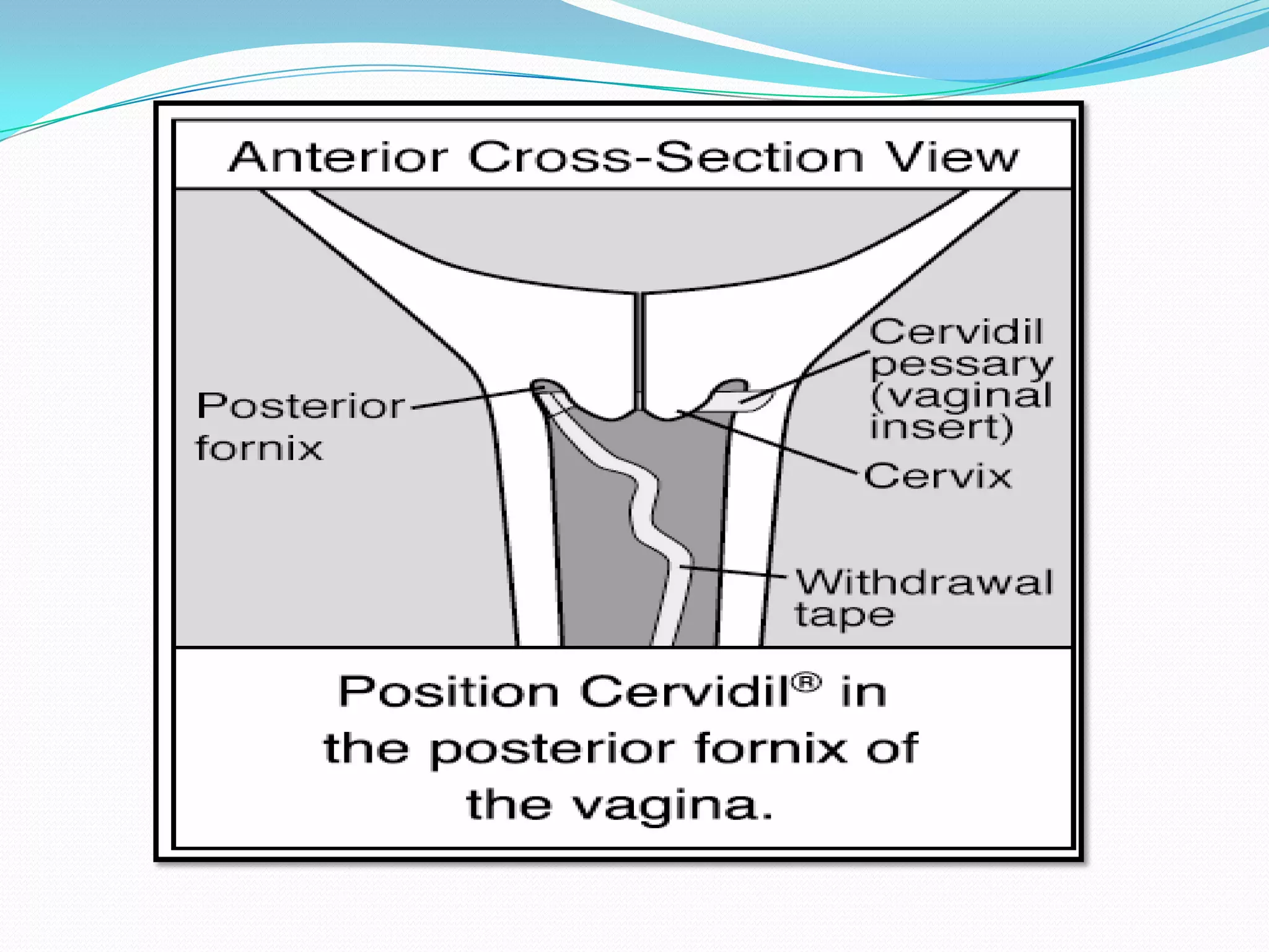Cervical ripening and labour induction | PPTX