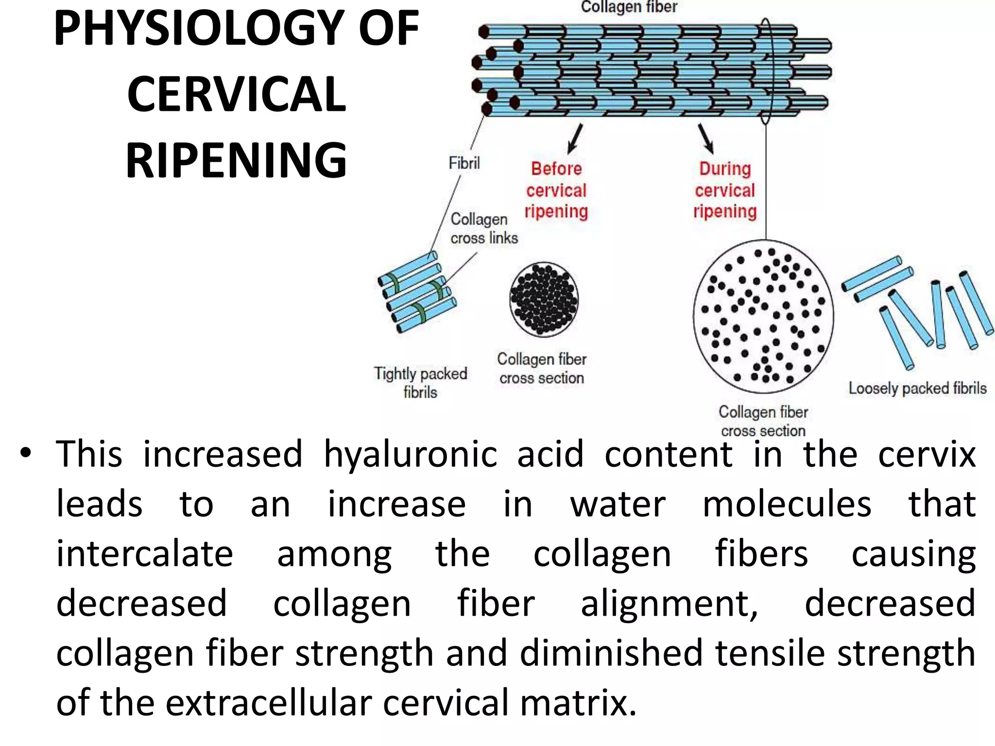 Cervical ripening and the bishop score | PPTX