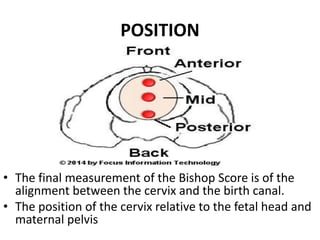 Cervical ripening and the bishop score | PPTX