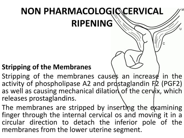 Cervical ripening and the bishop score | PPTX