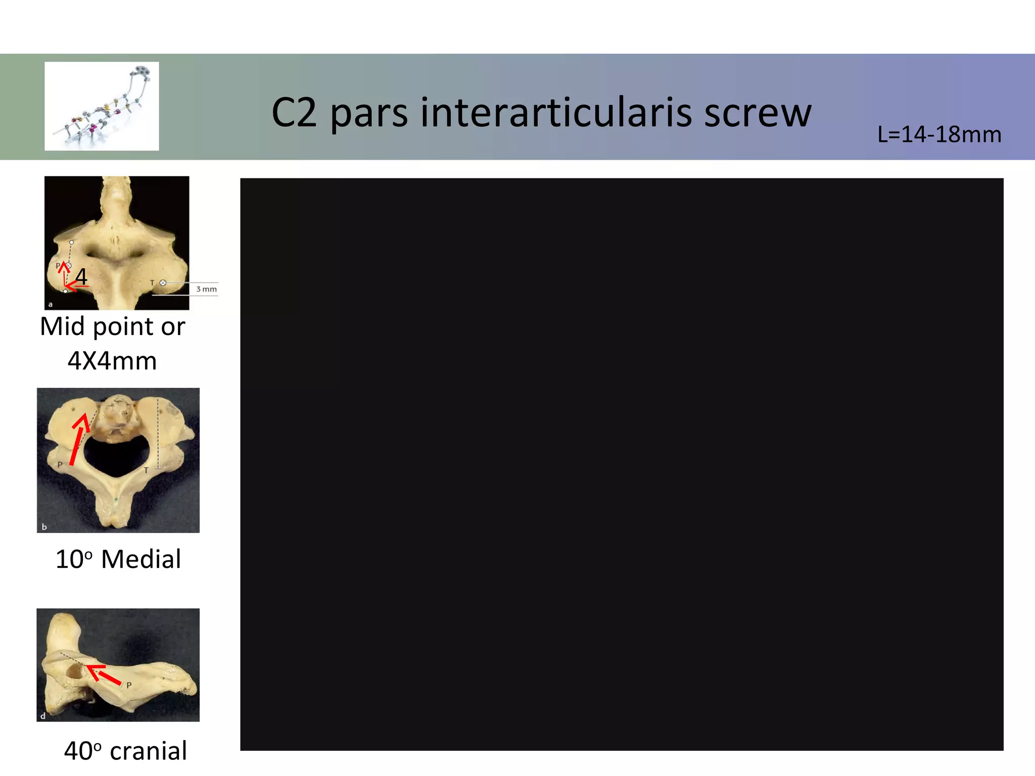 CervicalScrew2011 | PPT