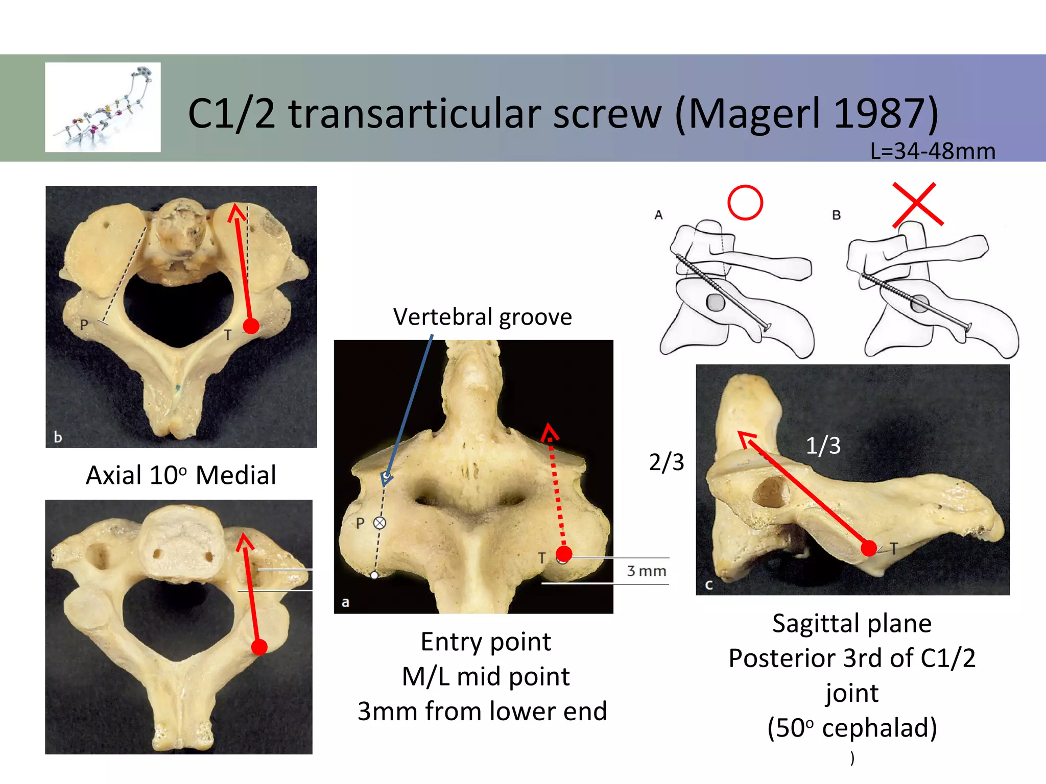 CervicalScrew2011 | PPT