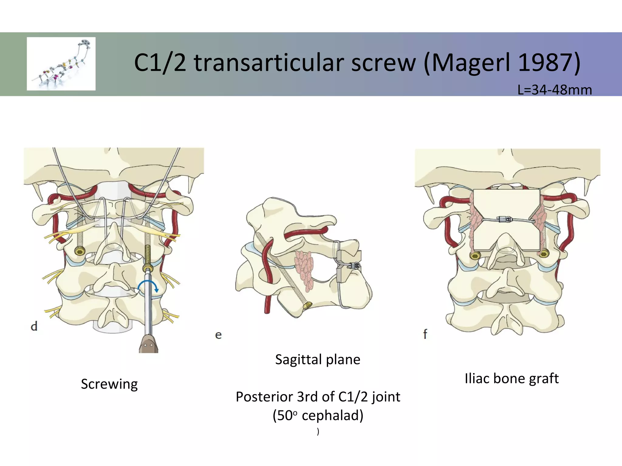 CervicalScrew2011 | PPT
