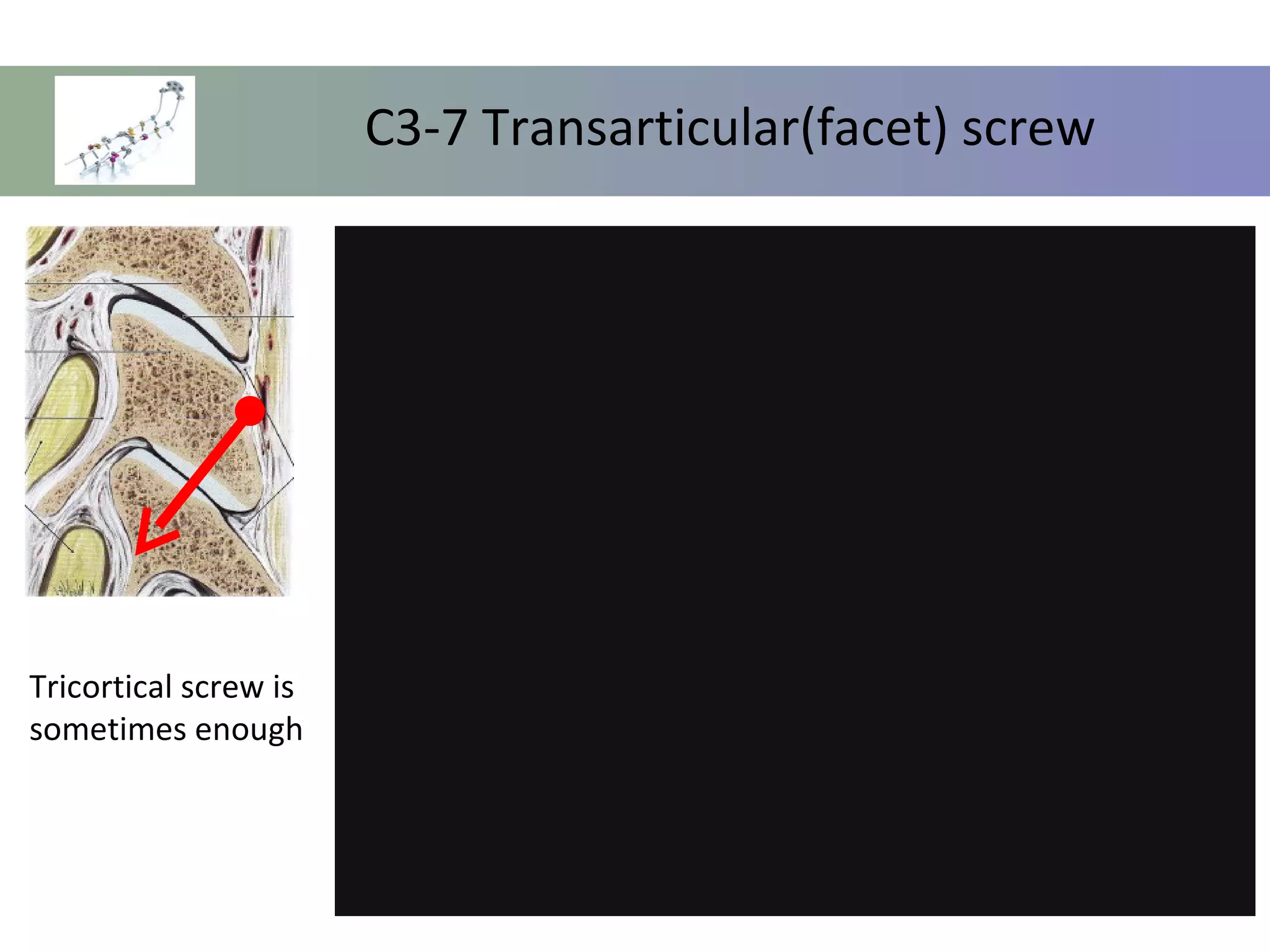 CervicalScrew2011 | PPT