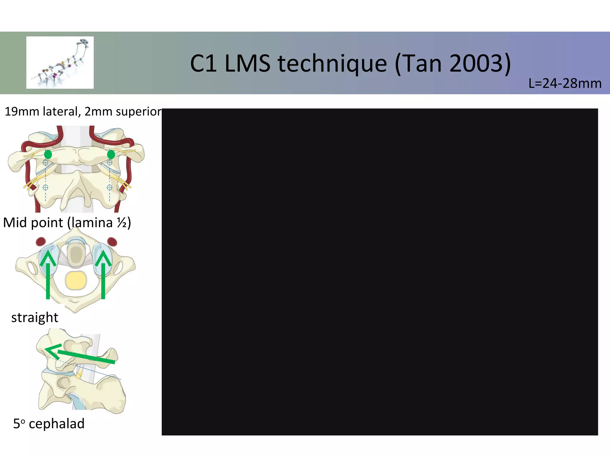 CervicalScrew2011 | PPT
