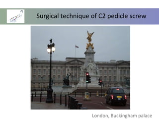 CervicalScrew2011 | PPT