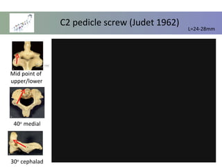 CervicalScrew2011 | PPT