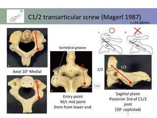 CervicalScrew2011 | PPT