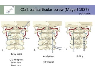 CervicalScrew2011 | PPT