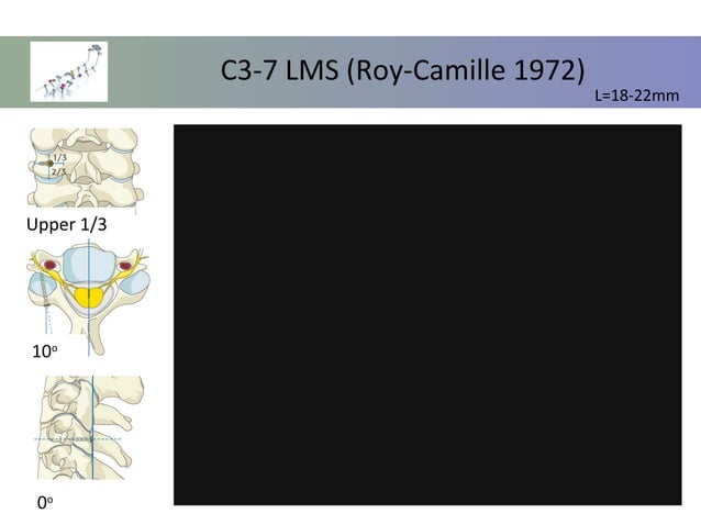 CervicalScrew2011 | PPT