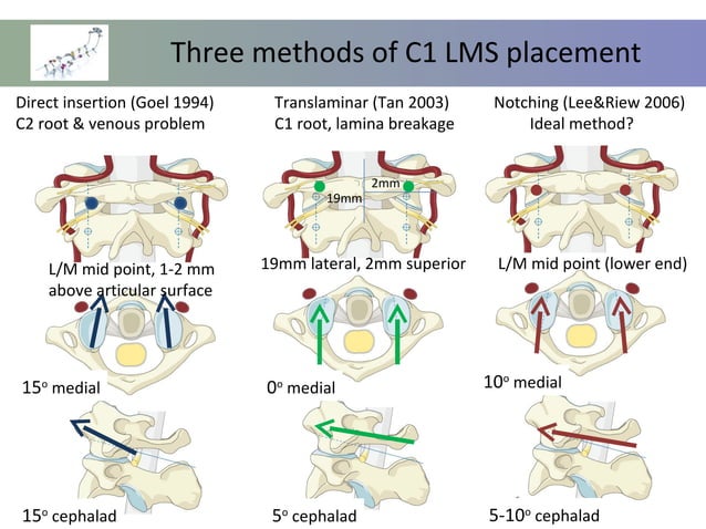 CervicalScrew2011 | PPT