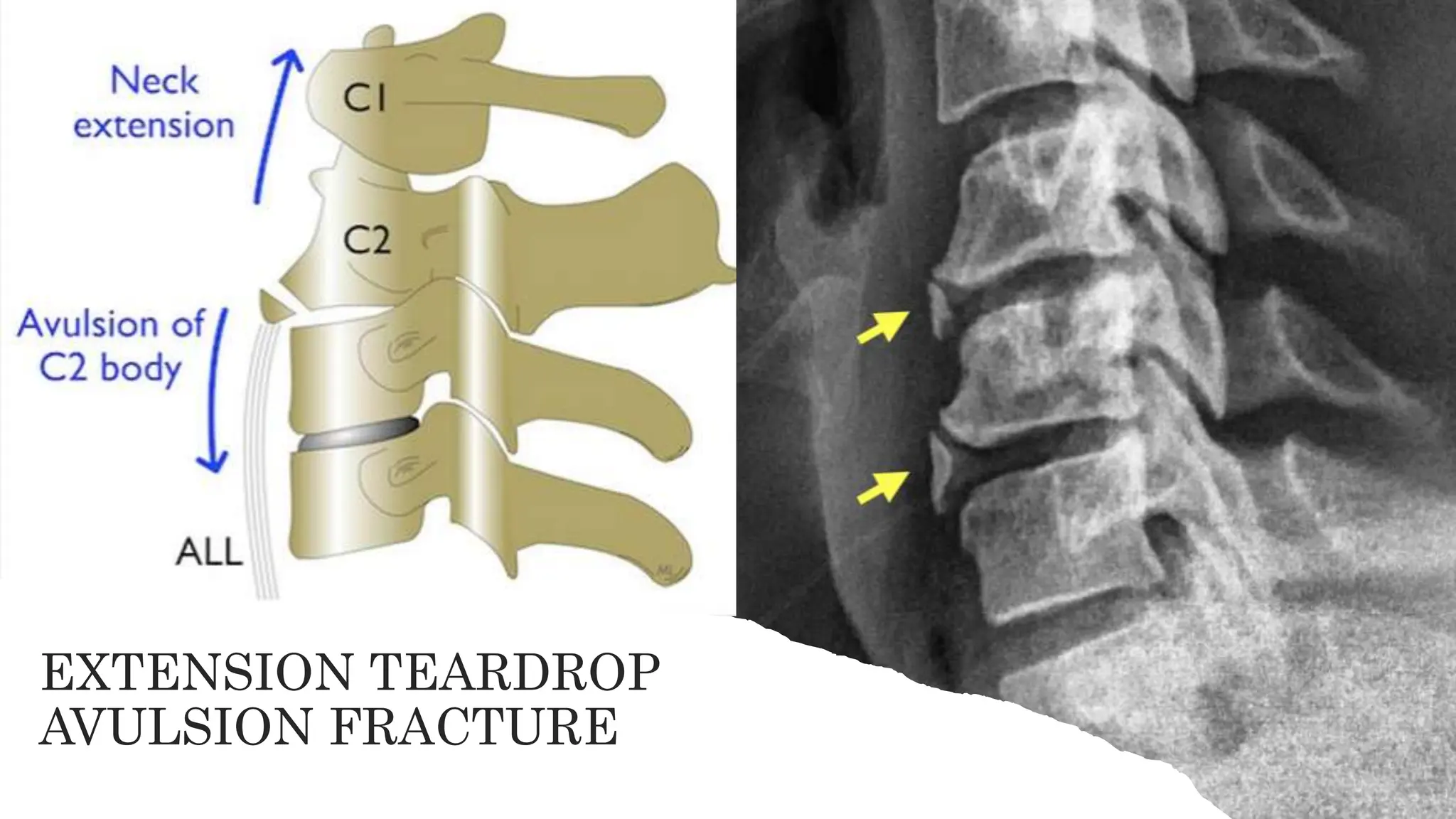 Cervical Spinal Cord Injury j- Yudi.pptx
