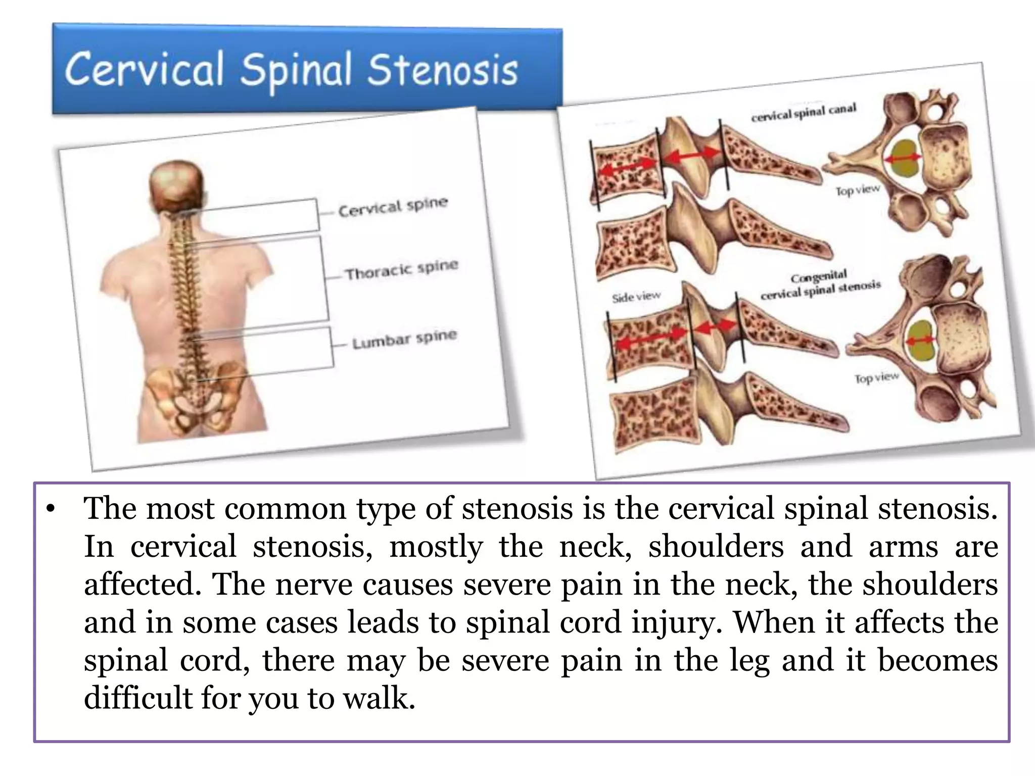 Cervical spinal stenosis | PPTX