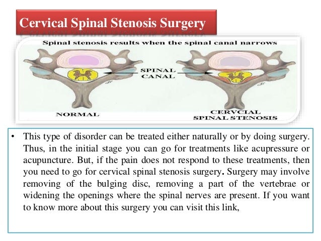 Cervical spinal stenosis