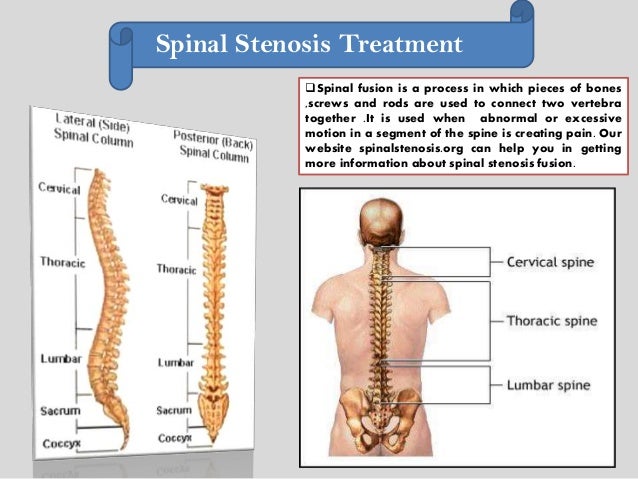 Cervical spinal stenosis surgery