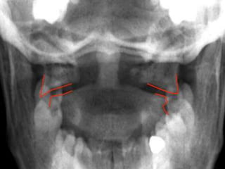 Imaging of the Cervical Spine Injuries.ppt